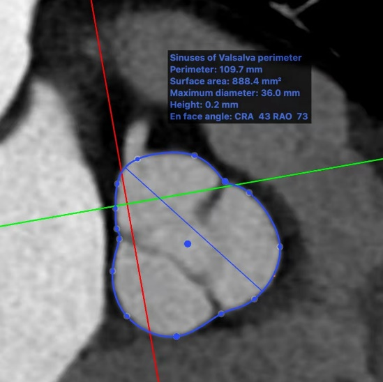 全球首例！四川大学华西医院陈茂教授团队完成全球首款全释放可回收自膨干瓣Venus-PowerX临床应用 -- 严道医声网