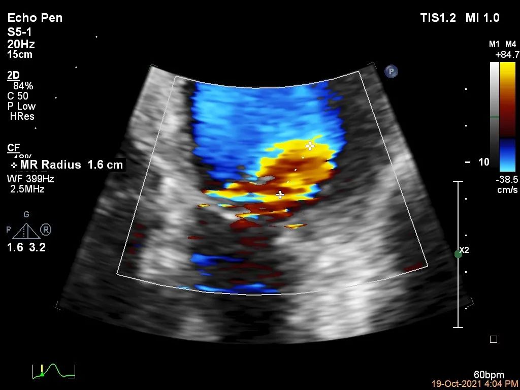 “贞”心一“课”｜二尖瓣后叶巨大脱垂TEER治疗1例 -- 严道医声网
