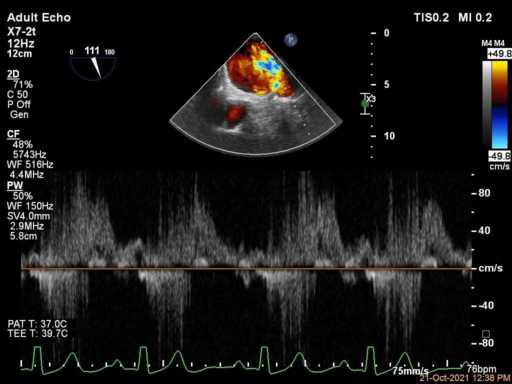 “贞”心一“课”｜二尖瓣后叶巨大脱垂TEER治疗1例 -- 严道医声网