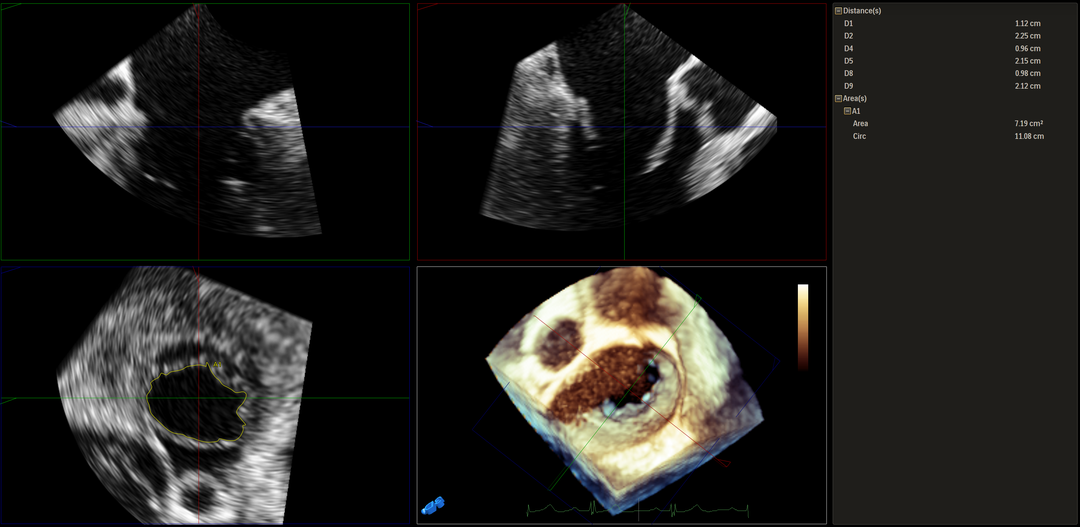 “贞”心一“课”｜二尖瓣后叶巨大脱垂TEER治疗1例 -- 严道医声网