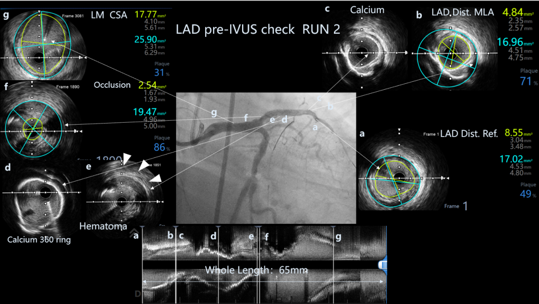 葛均波院士团队成功完成Judo系列导丝上市后全国首例临床应用 -- 严道医声网