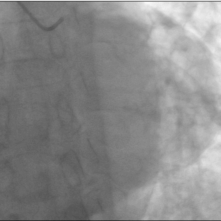 惊“心”动魄的救援｜IVUS病例大赛预热（一） -- 严道医声网