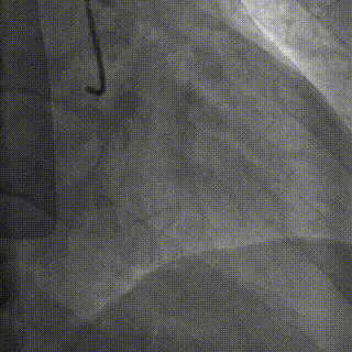 张斌教授成功完成华南区首例JUDO导丝临床应用 -- 严道医声网