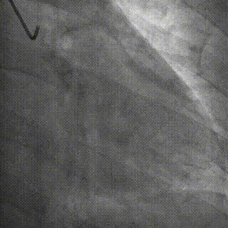 张斌教授成功完成华南区首例JUDO导丝临床应用 -- 严道医声网