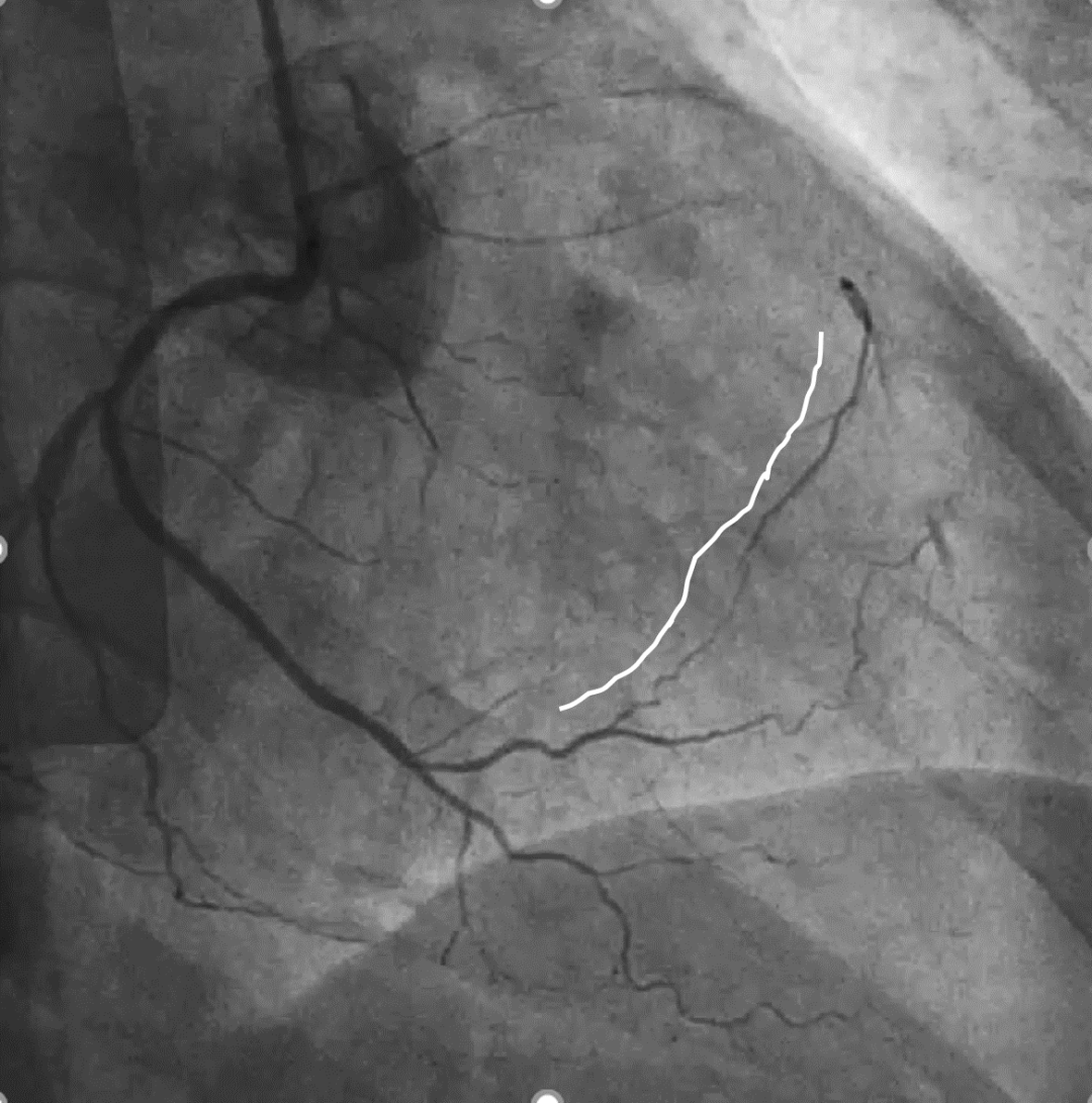张斌教授成功完成华南区首例JUDO导丝临床应用 -- 严道医声网