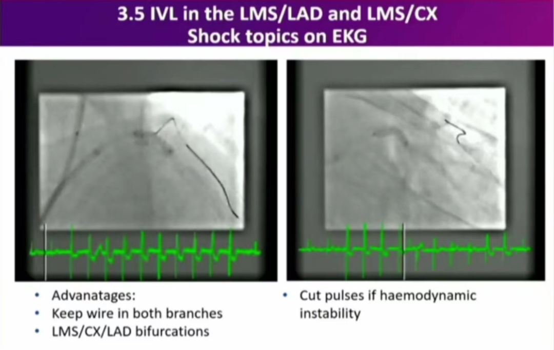 EuroPCR 2022｜实践出真知 畅享新科技：国际专家热议Shockwave IVL心动案例 -- 严道医声网