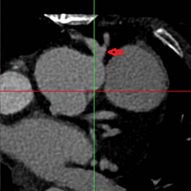 一瓣到位 Fei你莫属 | 全国3家中心完成启明医疗VenusP-Valve 国内首日商业植入 -- 严道医声网