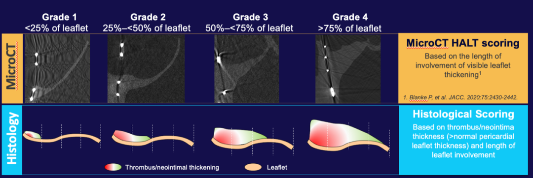 TCT 2022｜美敦力Late Breaking自膨式TAVR低衰减瓣叶增厚（HALT）的病理学研究结果公布 -- 严道医声网